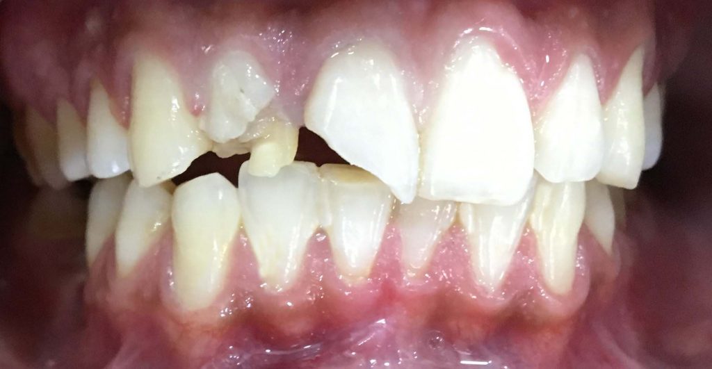 Case of Anterior Teeth Trauma: Management - Nawal's Dental Clinic